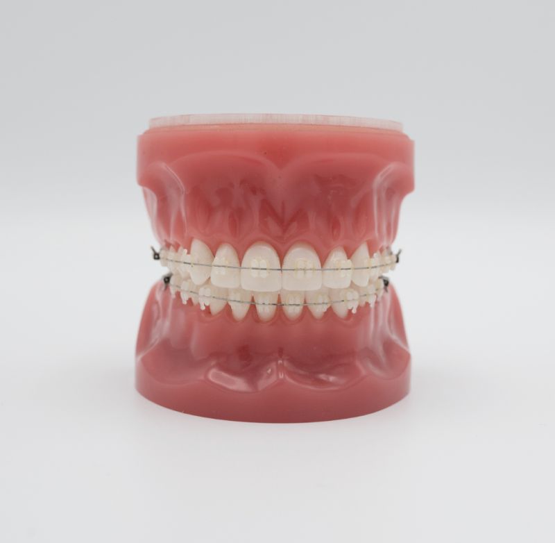 Fixed Braces - Knightsbridge & Kensington