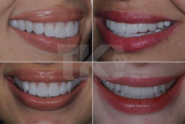 Non Prep Veneers: Comprehensive Guide To The Advantages