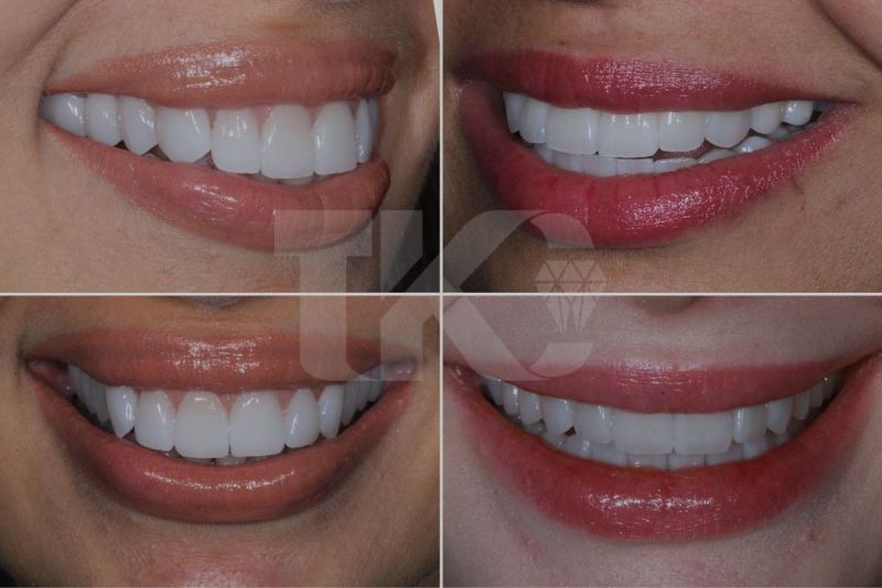 Non Prep Veneers: Comprehensive Guide To The Advantages