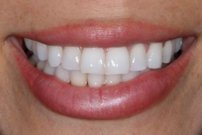 How Much Does Invisalign Cost? (UK 2025 Price Guide)