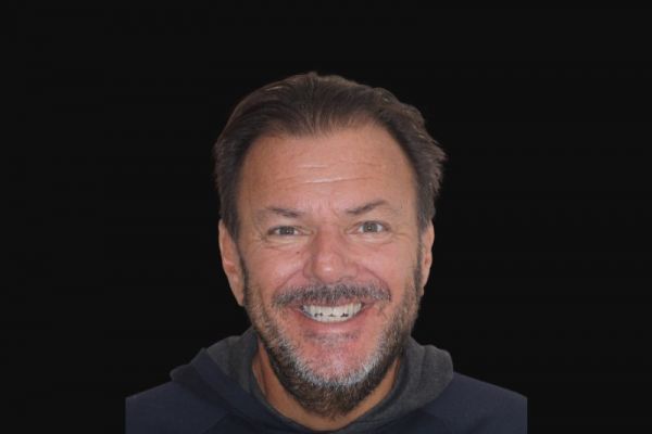 Porcelain Veneers And Crowns - Knightsbridge & Kensington