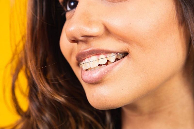 Braces Cost In The UK (2025): Complete Price Guide