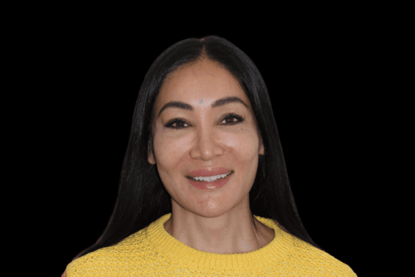 Porcelain Veneers And Crowns - Knightsbridge & Kensington