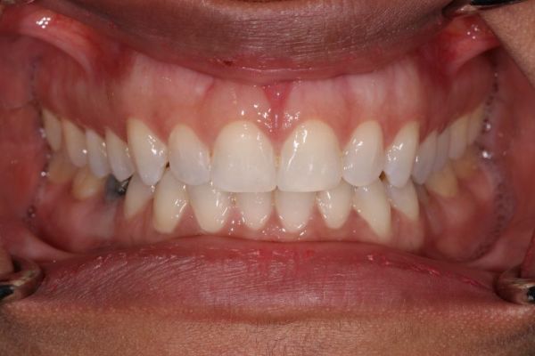 Gum Disease Treatment: Ultimate Guide To Your Options & Cost